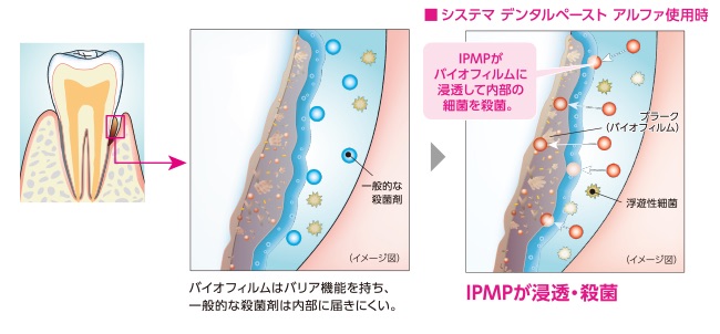 Systema Dentalpaste α ｜ DENT. | ライオン歯科材株式会社